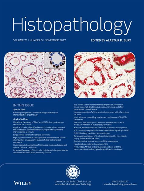 Uterine Tumour Resembling Ovarian Sex Cord Tumour First Report Of A