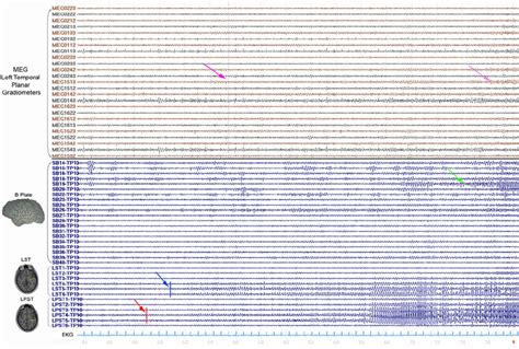 Waveforms Of Simultaneously Recorded Intracranial Eeg And Meg At Ictal