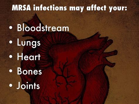 Staphylococcus Aureus Mrsa By Monet Chisholm