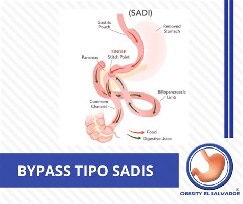 Bypass Tipo Sadis La Técnica Sadis Obesity El Salvador Facebook