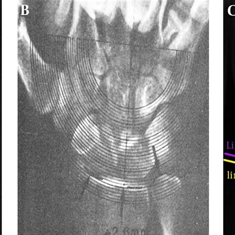 The Most Common Methods Of Ulnar Variance Assessment Download