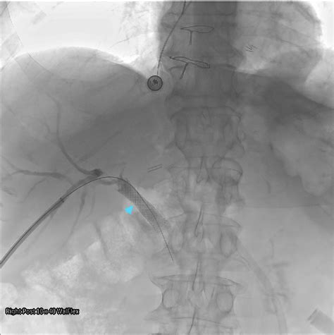 [pdf] Percutaneous Biliary Stent Removal For Benign Biliary Stricture Post Hepaticojejunostomy