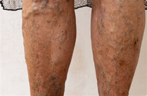 Peripheral Arty Disease