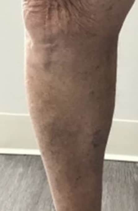 Varicose Veins Archives Vein Specialists Of Geneva Ltd