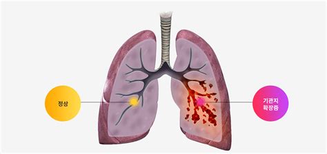 기관지 확장증 Bronchiectasis 원인 증상 진단 및 치료 예후