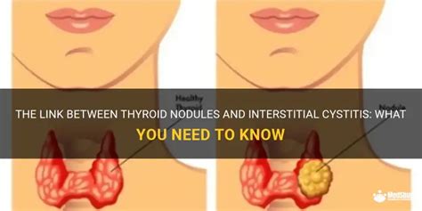 The Link Between Thyroid Nodules And Interstitial Cystitis What You
