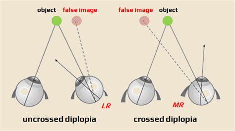Differential Diagnosis Of Diplopia Stroke Manual