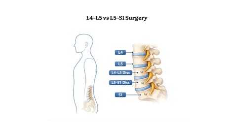 How Is L5 S1 Different From L4 L5 Disc Surgery Total Ortho Sports