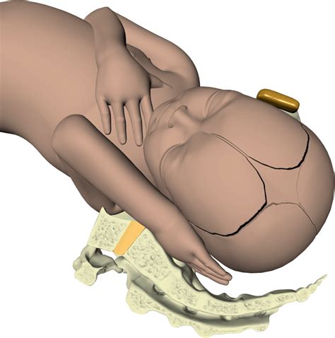Compound Presentation Maternity