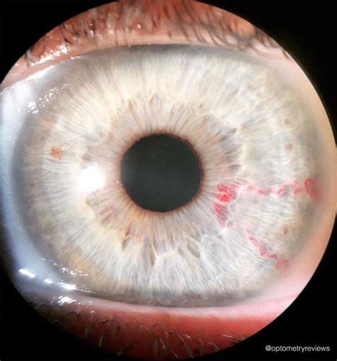 An Iris Arteriovenous Ophthalmology Notes And Synopses