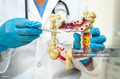 궤양성 대장염 장 맹장 및 소화 시스템 병원에서 연구 진단 및 치료를 위한 해부학 모델을 들고 있는 의사 간 내부 기관에 대한 스톡 사진 및 기타 이미지 Istock