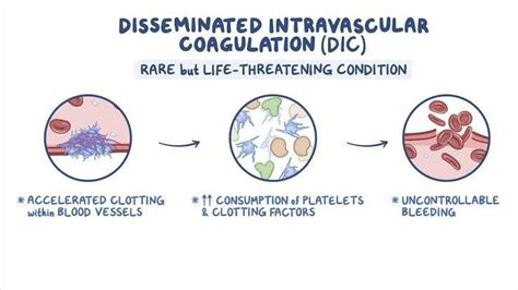 Disseminated Intravascular Coagulation MEDizzy