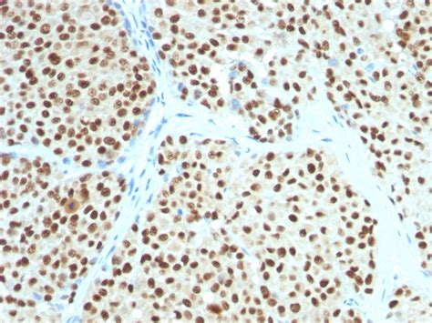 Sox10 Melanoma Marker Antibody Clone Sox10991 Gene Id 6663