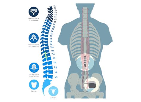 Epidural Stimulation