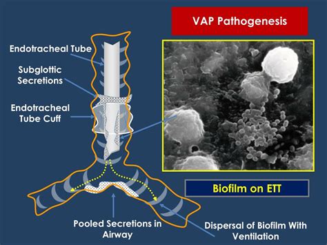 Ppt Vap A Preventable Disease Powerpoint Presentation Free Download