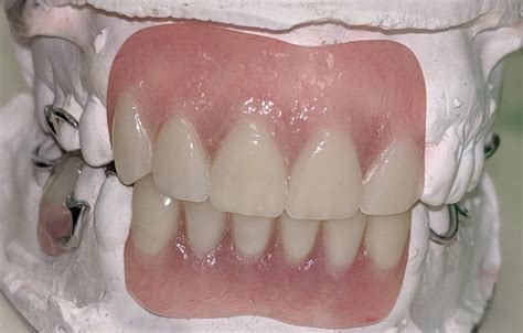 Cast Metal Partials Gretna Durable And Precise Tooth Replacement