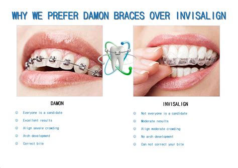 Invisalign Brackets Assetgugl