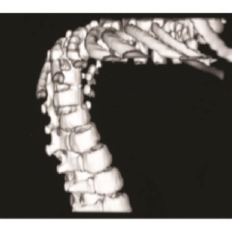 A Sagittal Cut Of A Ct Scan Myelogram Of The Spine Showing Kyphosis