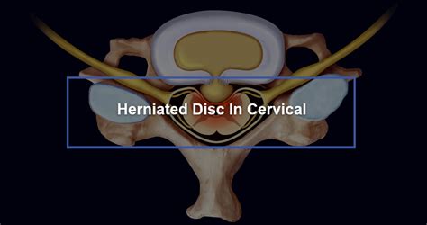 Herniated Disc In Cervical Dr Kevin Pauza The Discseel® Procedure Inventor
