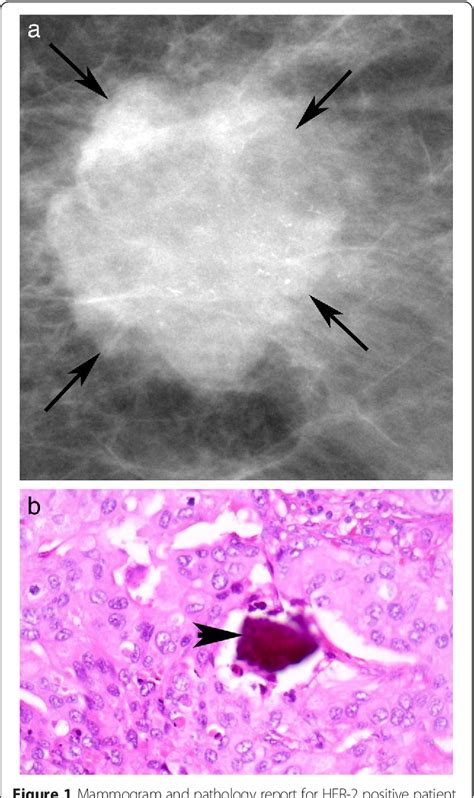 Figure 1 From Mammographic Microcalcifications And Breast Cancer Tumorigenesis A Radiologic