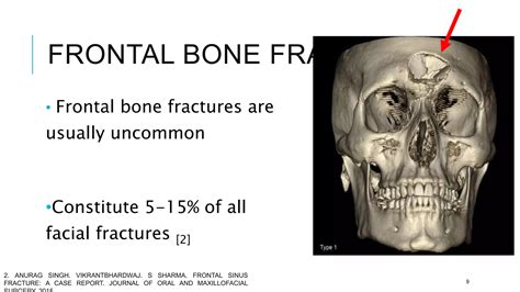Case Report Frontal Bone Fracture Junaidpptx