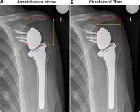 Reverse Shoulder Arthroplasty Design—inlay Vs Onlay Does It Really