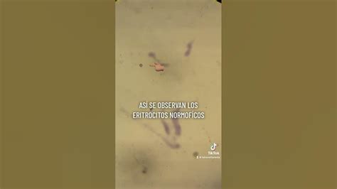 Eritrocitos En Una Muestra De Orina Labclinico🦠🔬 Ego Eritrocito