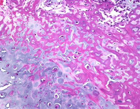 Osteosarcoma Histology Classical Osteoblastoma Atypical