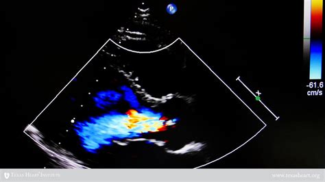 Can I Sit Up For An Echocardiogram The Texas Heart Institute®