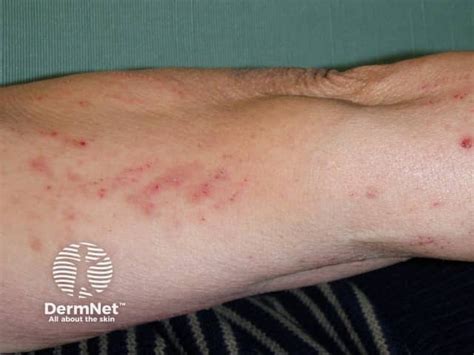 Causes And Treatment Of Pruritus Itchy Skin Uraemic Pruritus Renal