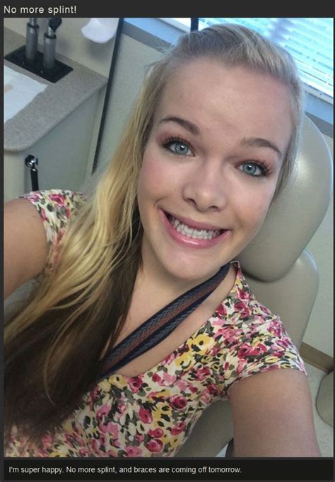 Before And After Jaw Surgery Others