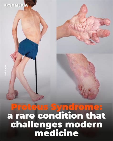 The Enigma Proteus Syndrome Is An Extremely Rare Genetic Disorder