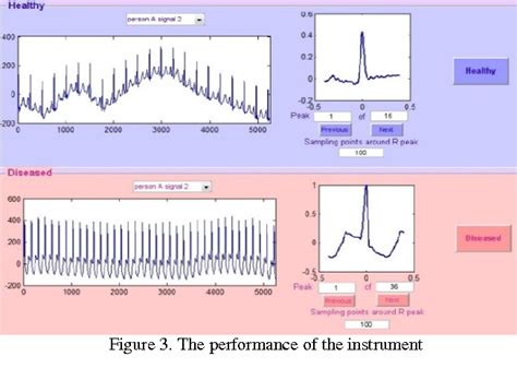 Figure 3 From A Tool For Ecg Signal Analysis Using Standard And Optimized Hermite Transform