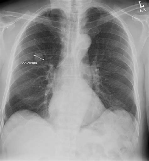 Cxr Demonstrating Increased Rul Nodule Size To 2 2 Cm Download Scientific Diagram