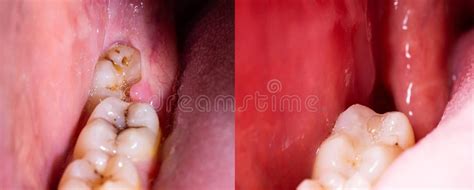 Photo Before And After Removal Of An Impacted Wisdom Tooth A Cavity In