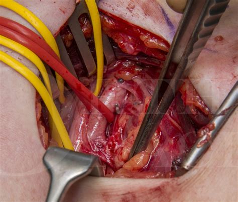 Revision Thoracic Outlet Decompression For Pectoralis Minor Syndrome Surgical Technique Orthoracle