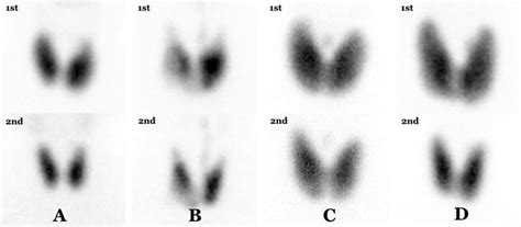Graves Disease Thyroid Scan Radioiodine Treatment For Hyperthyroid