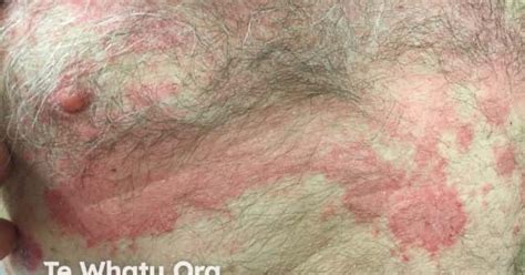 Chronic Plaque Psoriasis Image