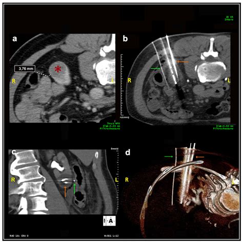 Percutaneous Ct Guided Renal Cryoablation Technical Aspects Safety