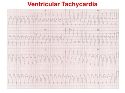 Qrs Interval In Ecg And Its Abnormalities Pptx