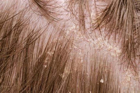 What Are The Common Causes Of A Dry Scalp With Greasy Hair