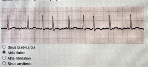 Solved Sinus Bradycardia Atrial Flutter Atrial Fibrillation