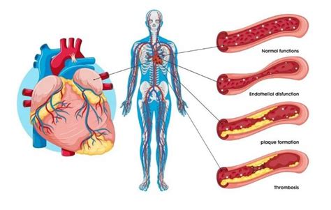 고지혈증에 나쁜 음식 좋은 음식 영양제 추천 건강한 혈관 만들기 지식정보리뷰