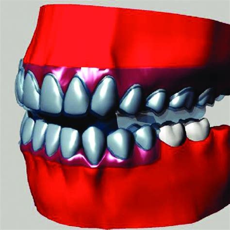 Pdf Clear Twin Block A Step Forward In Functional Appliances