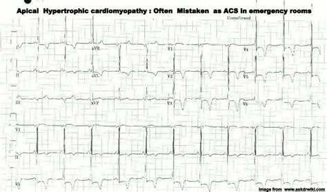 Apical Hypertrophy Dr S Venkatesan Md