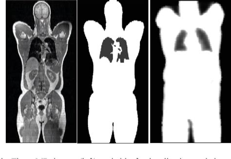 Figure 2 From Mr Based Attenuation Correction For A Whole Body