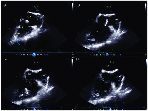 Concomitant Occurrence Of Fg And Sg And Their Fate Imaged By 2d Tee Download Scientific Diagram