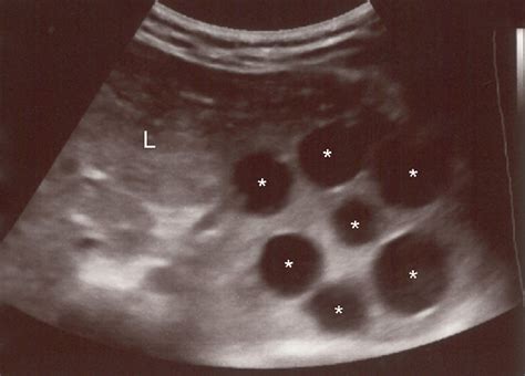 Transverse Scan With A Curvilinear Transducer Showing The Presence Of Download Scientific