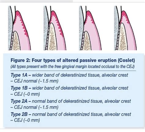 Lect 8 Periodontal Surgical Considerations For Esthetics 102723