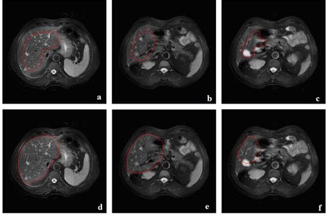 A B C Initial Contour Shape Of The Segmented Liver From Previous